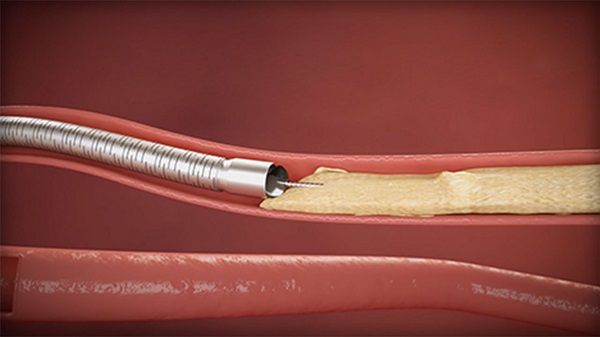 Atherectomy - Best Medical Care Service, Medical Arrow - Medical ...