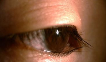 Epiblefaron - Best Medical Care Service, Medical Arrow - Medical ...