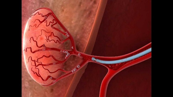 Embolization - Best Medical Care Service, Medical Arrow - Medical ...